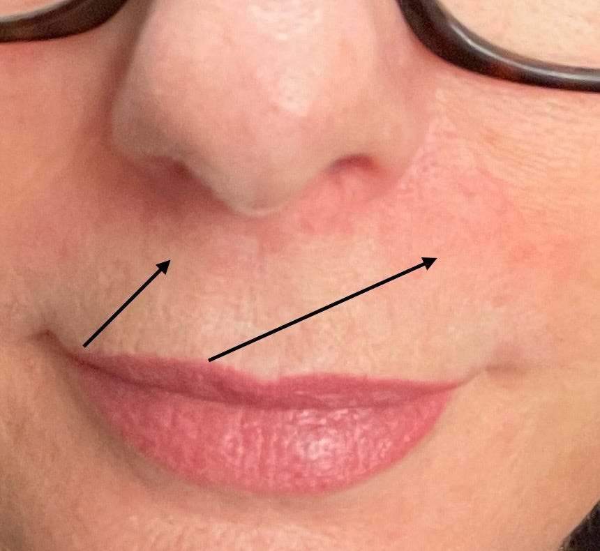 Perioral Dermatit och Rosacea | Monas Universum | Amelia