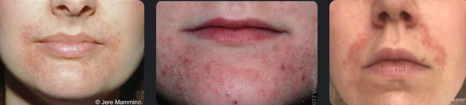 Perioral Dermatit och Rosacea | Monas Universum | Amelia